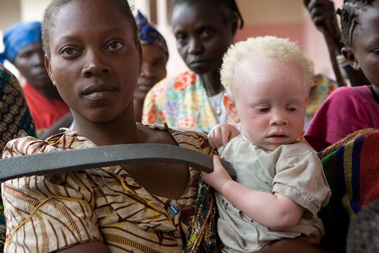 Understanding albinism and how to take care of albinos in Nigeria ...